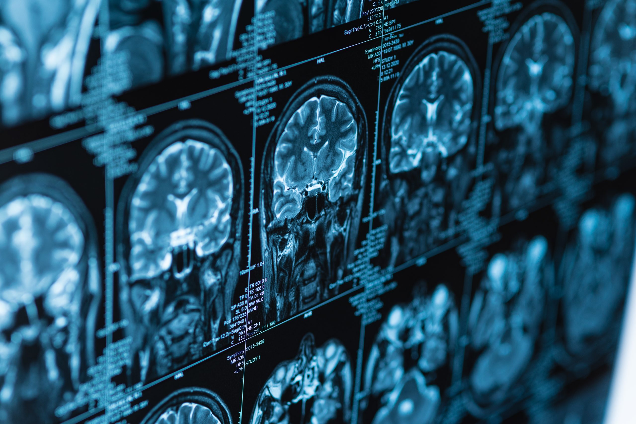 New brain health platform in Hamilton aims to revolutionize treatment ...
